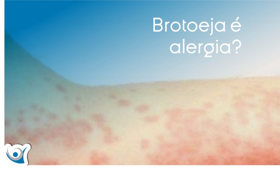 Brotoeja é alergia? - Alergoclínica | Clínica de Alergias