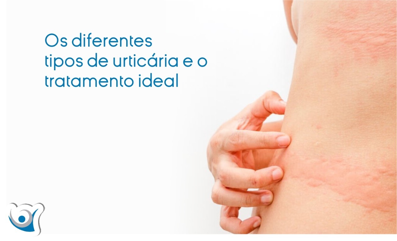 Os Diferentes Tipos De Urticária E O Tratamento Ideal Alergoclínica