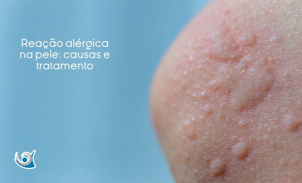 Reação alérgica na pele: causas e tratamento - Alergoclínica